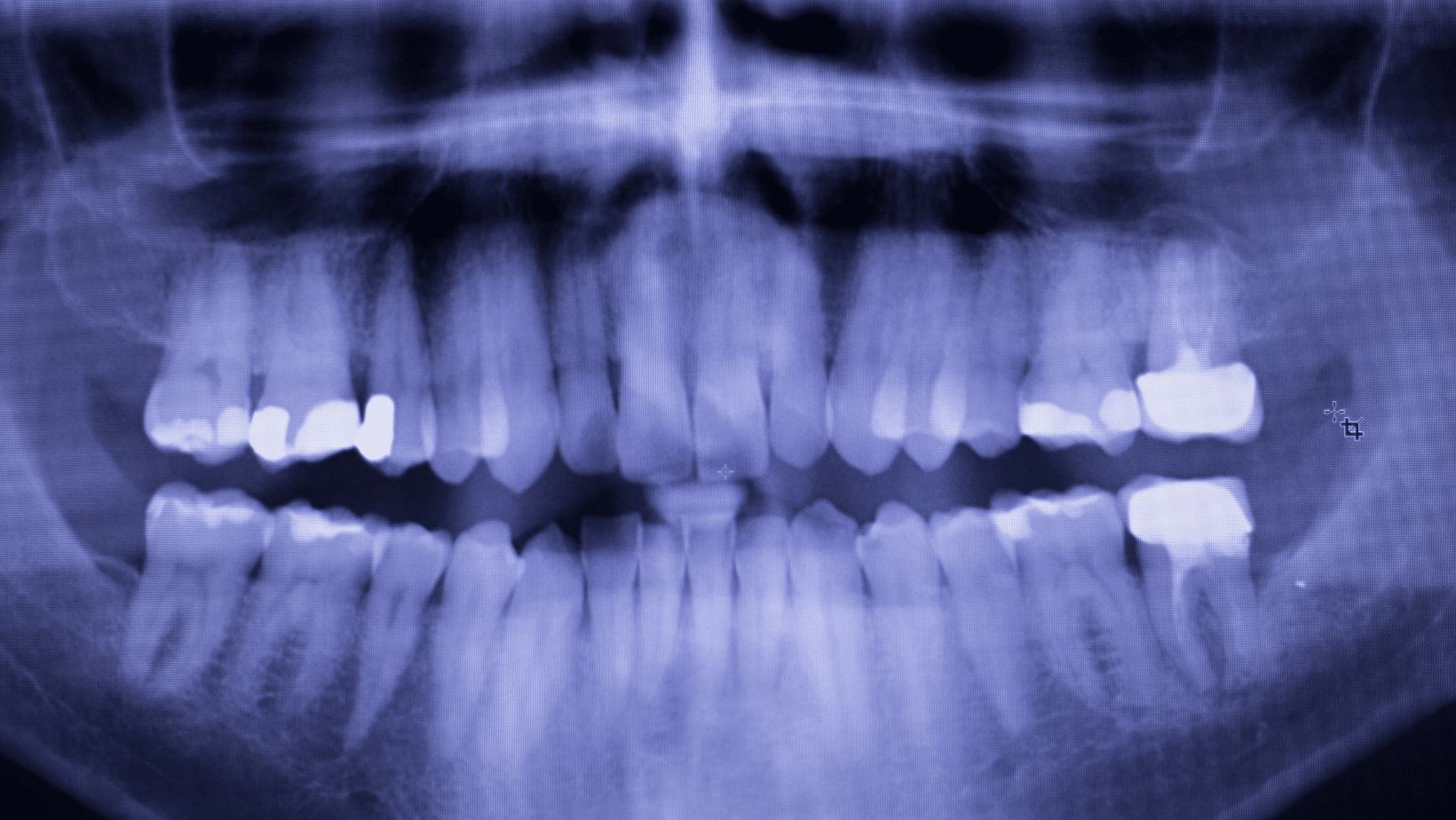 Affordable Dental Fillings | Toups Family Dentistry 337-237-7005